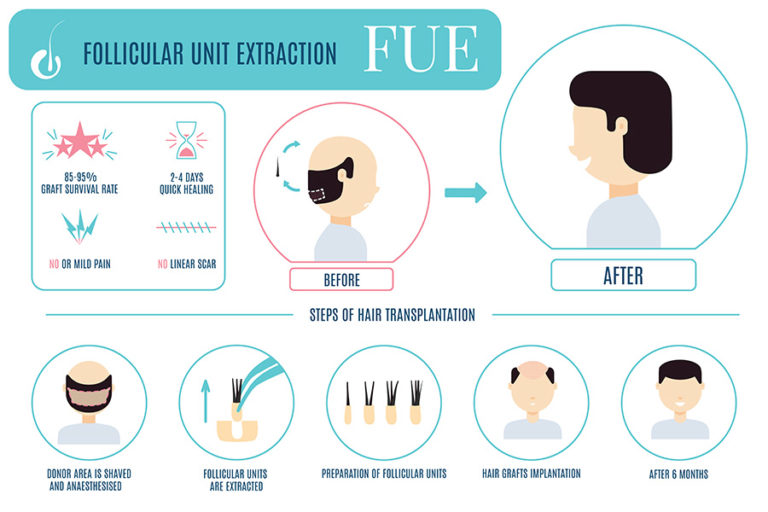 FUE Hair Transplant - Central Florida Hair Restoration